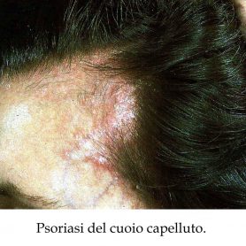 La Psoriasi del cuoio capelluto - Società Italiana di Tricologia